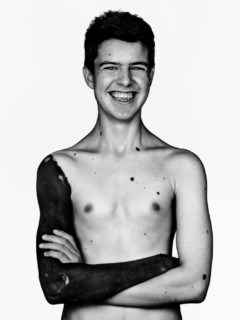 Portraits of People with an Ultra-Rare Type of Body-Covering Birthmark ...