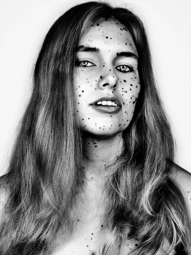 Portraits of People with an Ultra-Rare Type of Body-Covering Birthmark ...