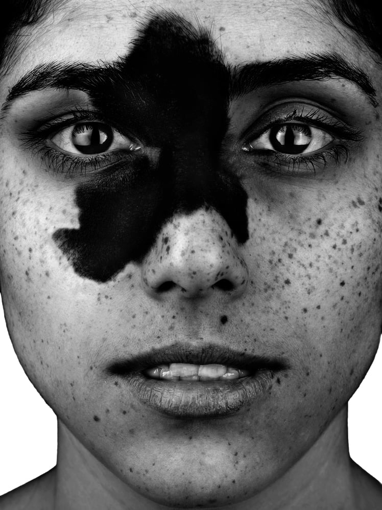 Portraits of People with an Ultra-Rare Type of Body-Covering Birthmark ...