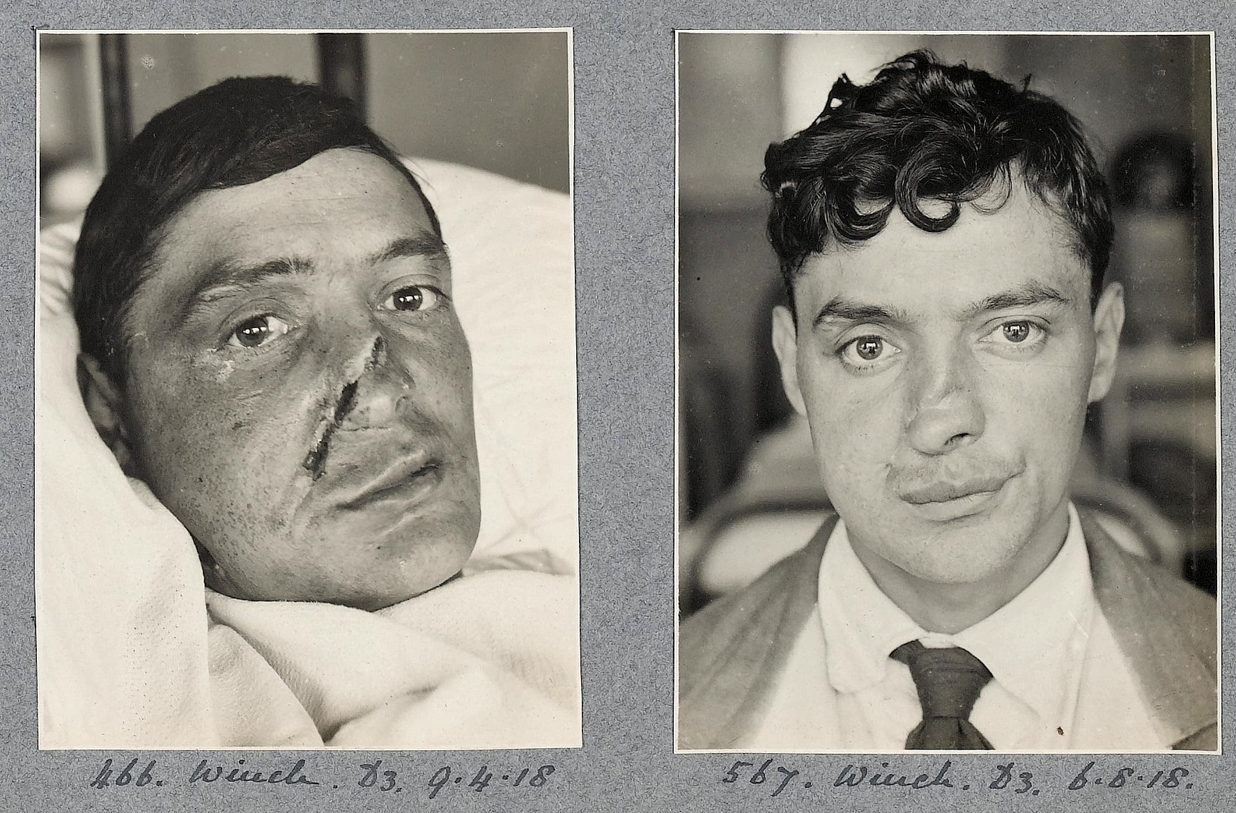 Photos Showcase Pioneering Plastic Surgeon's Work on WW1 Soldiers ...