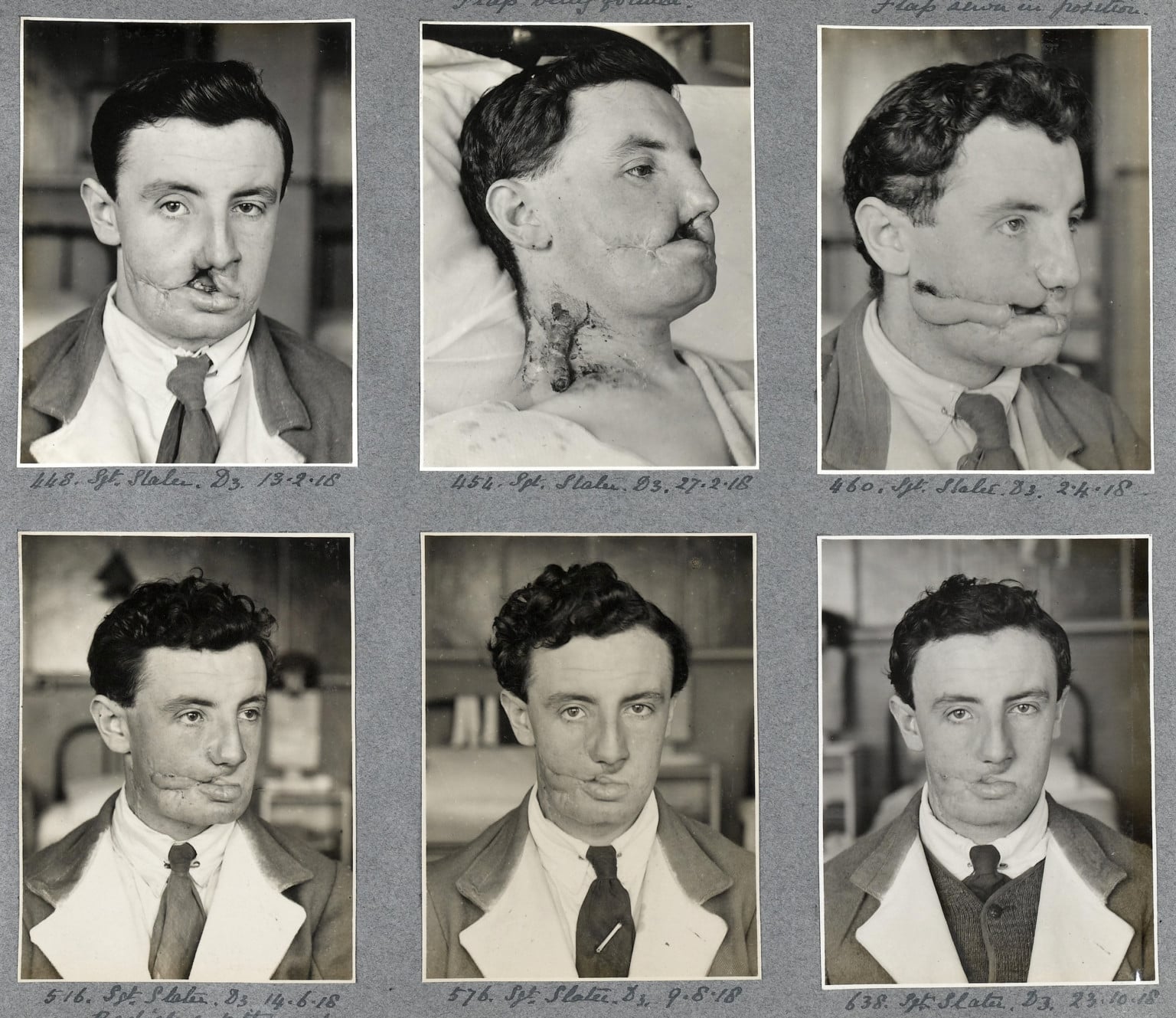 Photos Showcase Pioneering Plastic Surgeon's Work on WW1 Soldiers ...