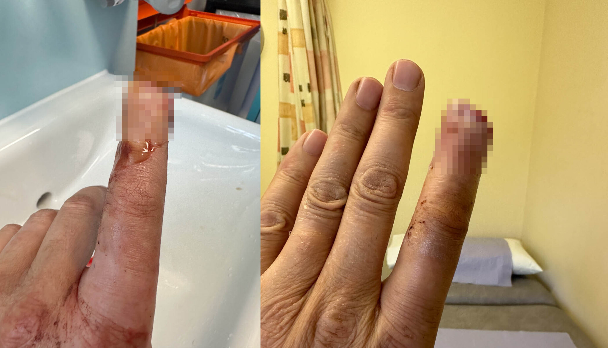 Photographer Loses Part of Finger After Tripod Snaps Shut | PetaPixel