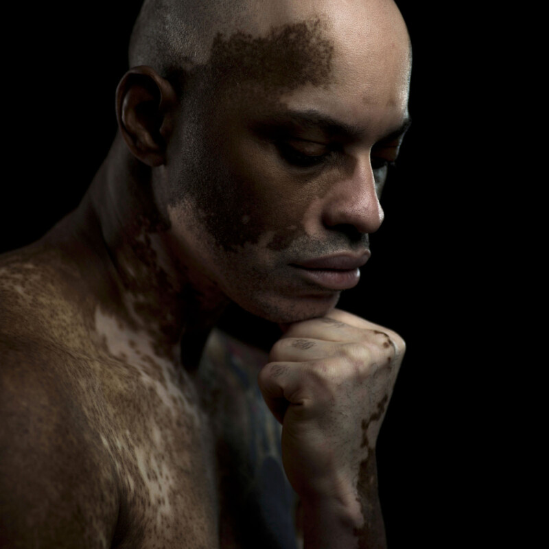 'Unusual Beauty' Photo Series Celebrates Rare Skin Conditions | PetaPixel